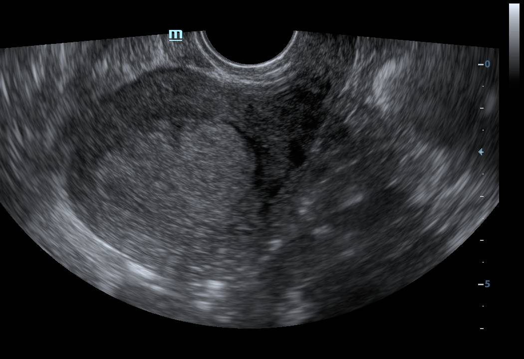 Post partum Mass In The Uterine Cavity ScholarMD Post partum Mass In The Uterine Cavity ScholarMD