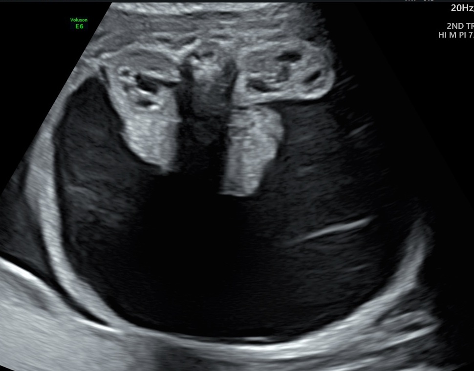 Unilateral Renal Agenesis Ultrasound Vs Pelvic Kidney