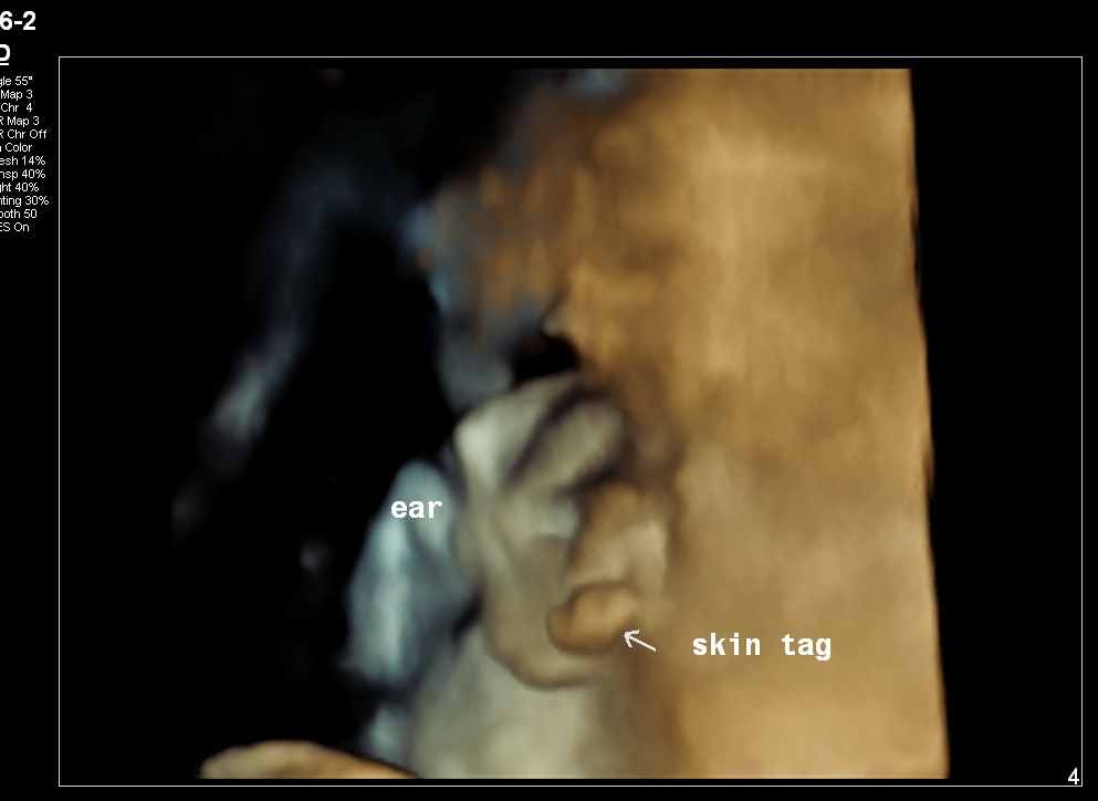 Pedunculated Skin Polyp